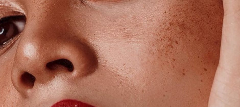 Blackheads: Identifying the Causes and Best Treatments - Ezilon Articles